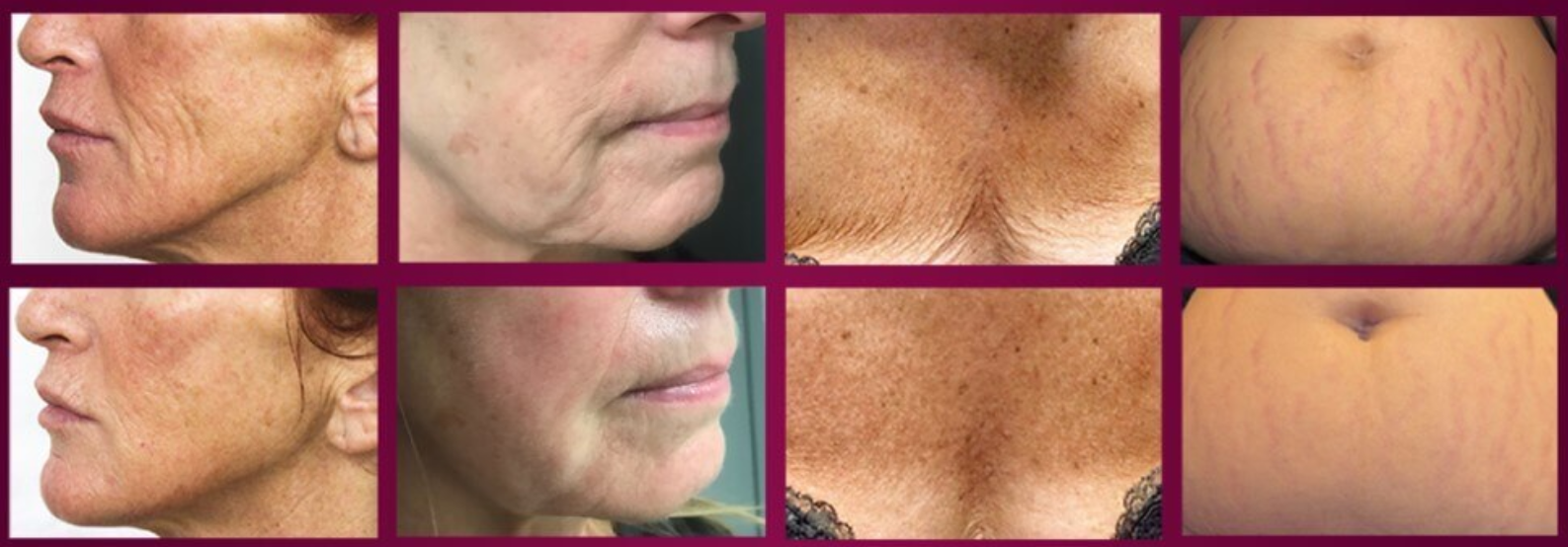 PRX DERM PERFEXION – Elite Body Contour & Drip Bar